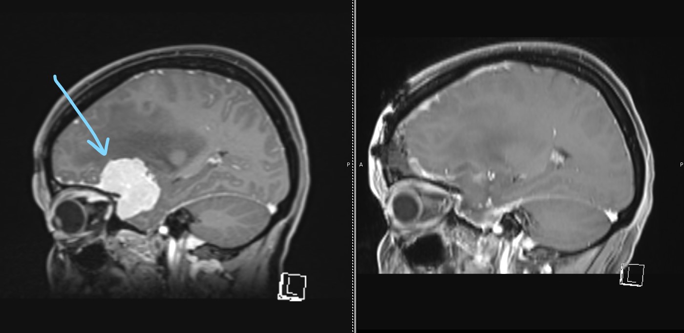 Meningioma Ashwin Kamath MD Meningioma Ashwin Kamath MD